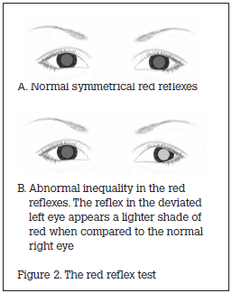 Screening for Strabismus | Squint Examination - Utsav Eye Clinic