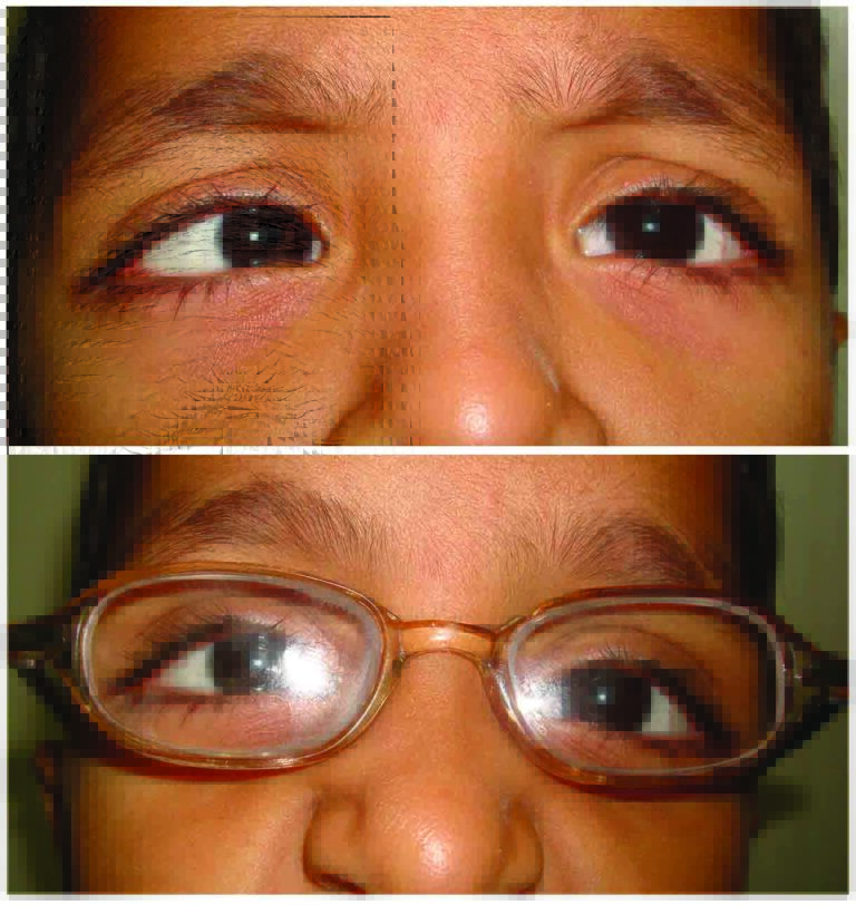 Best Squint Specialist in Mumbai India: Dr Anand Kumar - Utsav Eye Clinic